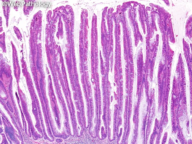 Histologia Do Adenoma Viloso File:Colonic Adenocarcinoma Ex Villous