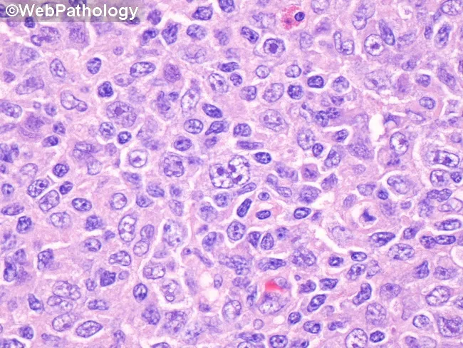 Infectious Mononucleosis - Tonsils