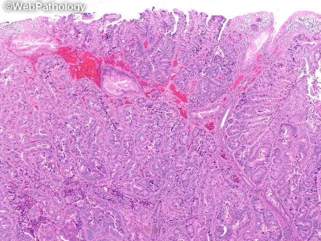 Intramucosal CA in a Polyp