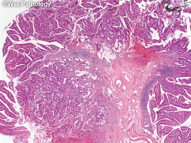 Intramucosal CA in a Polyp