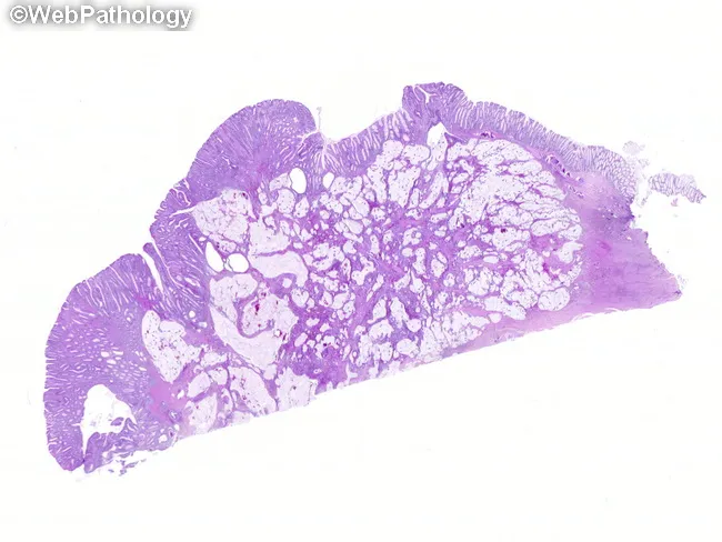 Colon Polyps : Treatment - 2