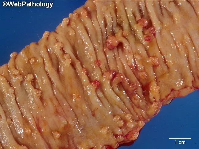 adenomatous polyps