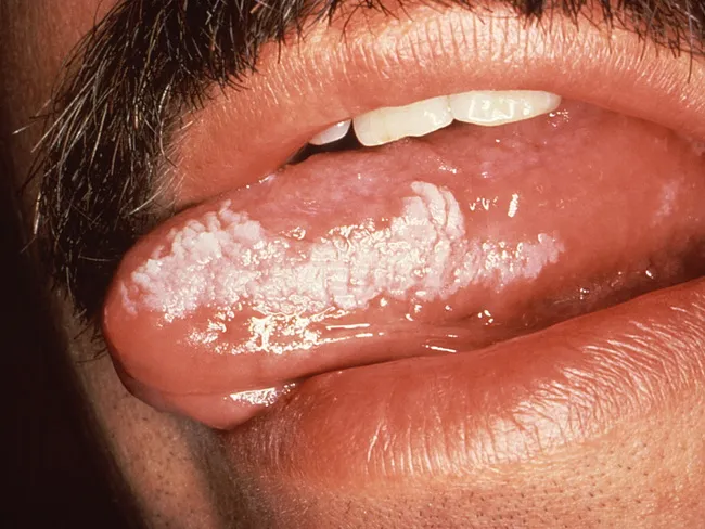 leukoplakia tongue histology