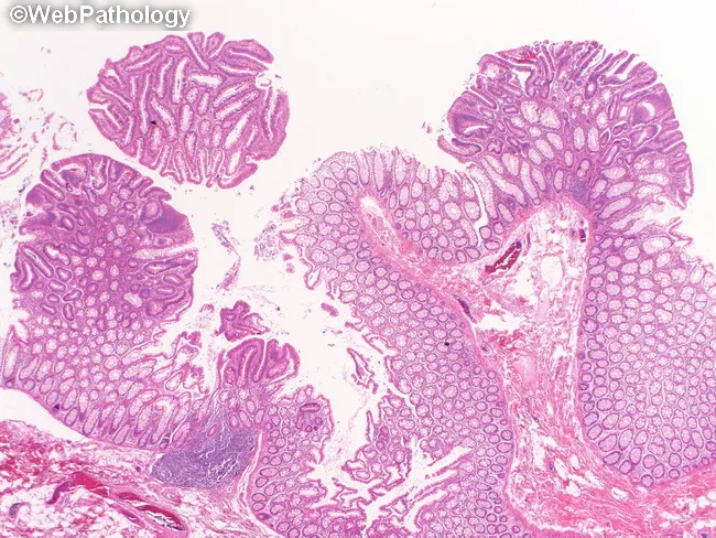 Familial Adenomatous Polyposis