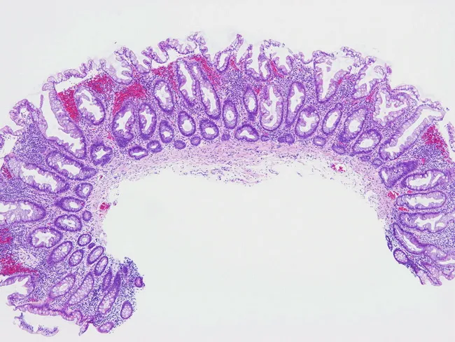Hyperplastic Polyp