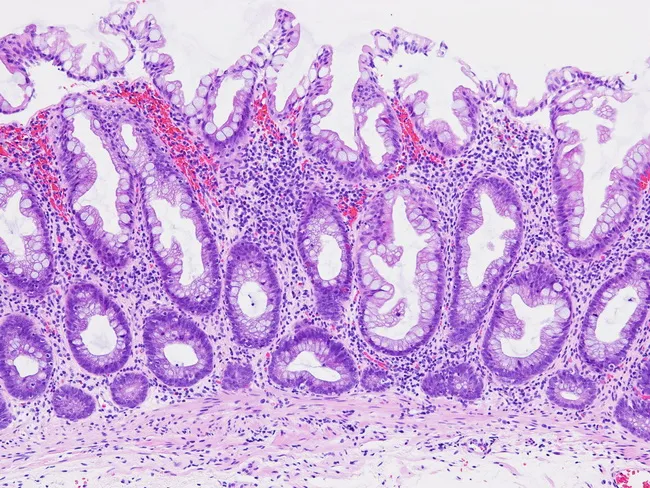 Hyperplastic Polyp