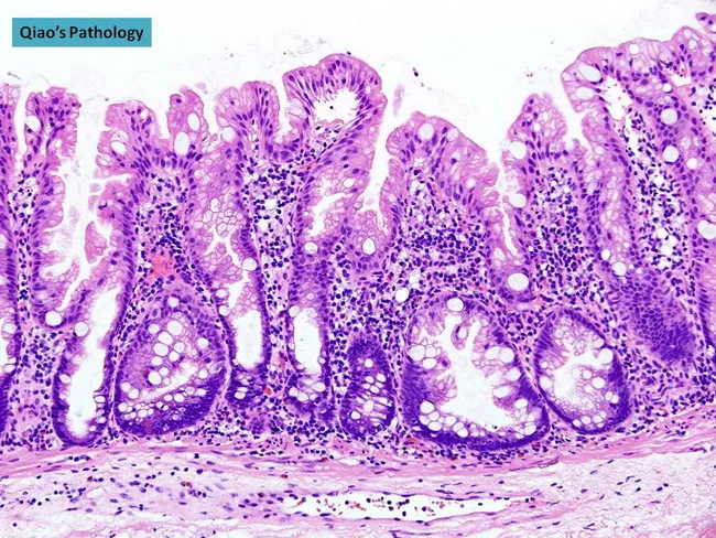 sessile hyperplastic polyps