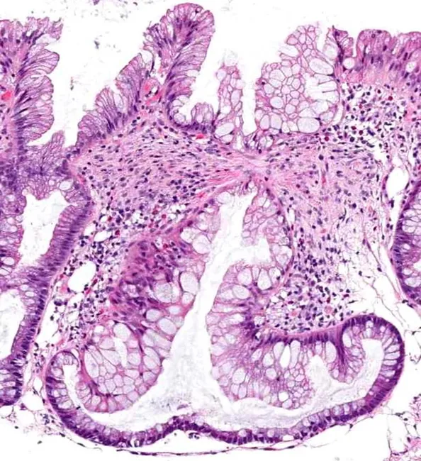 Serrated Polyp Pathology Outlines