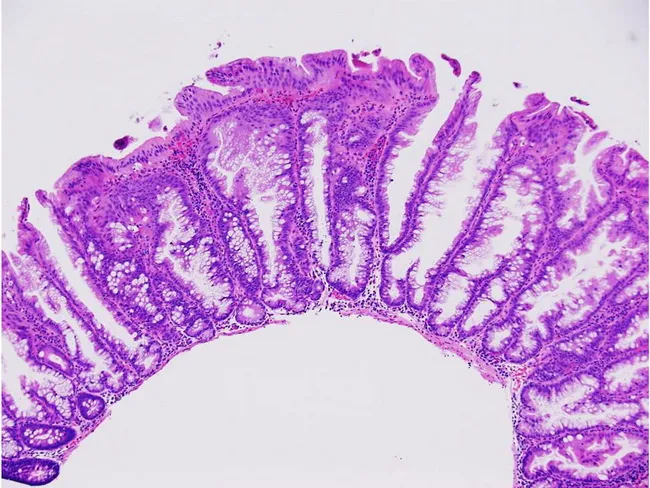hyperplastic polyp sawtooth