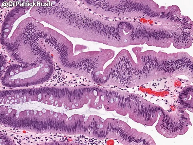 Traditional Serrated Adenoma