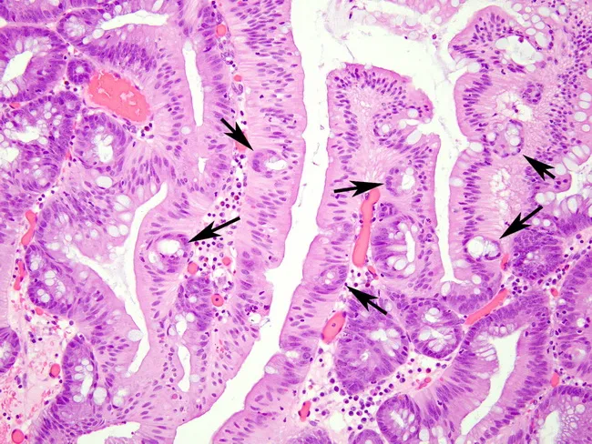 Traditional Serrated Adenoma