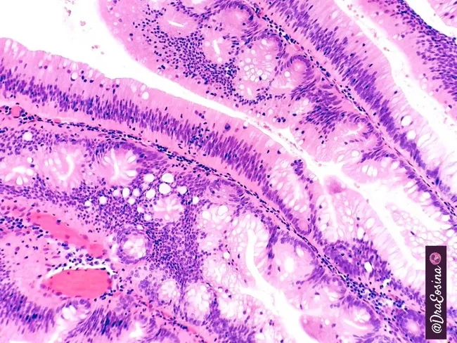 Traditional Serrated Adenoma