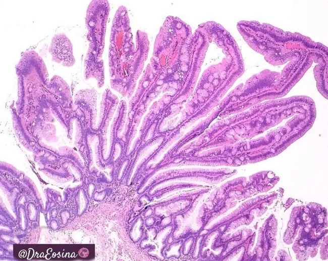 Traditional Serrated Adenoma