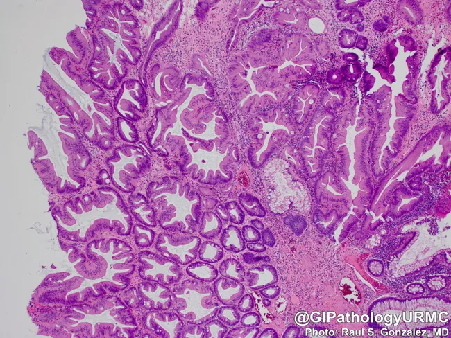 Traditional Serrated Adenoma : Dysplasia