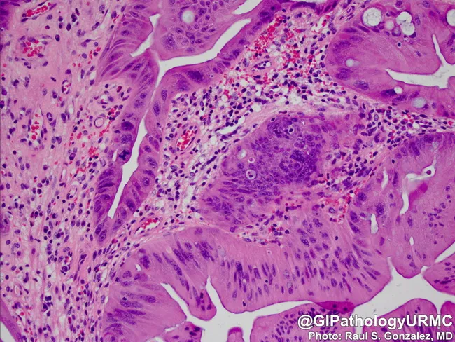 Traditional Serrated Adenoma : Dysplasia