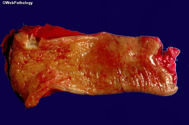 AdenoCA of Colon : Linitis