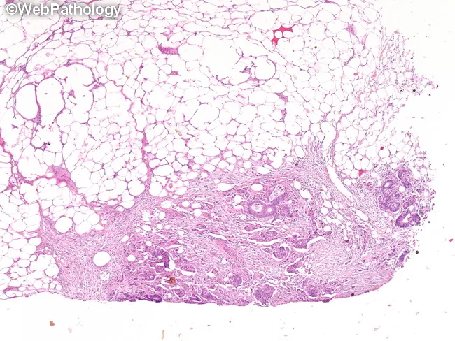 AdenoCA of Colon : Pericolonic Tumor Deposits