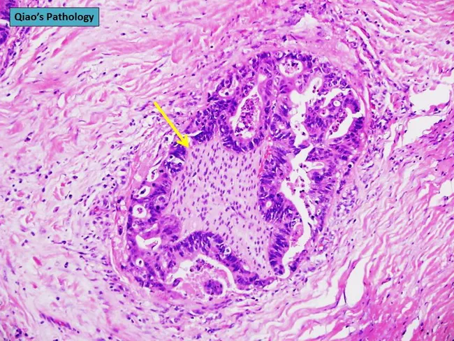 AdenoCA of Colon : Perineural Invasion