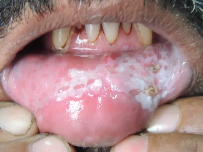 leukoplakia lip code