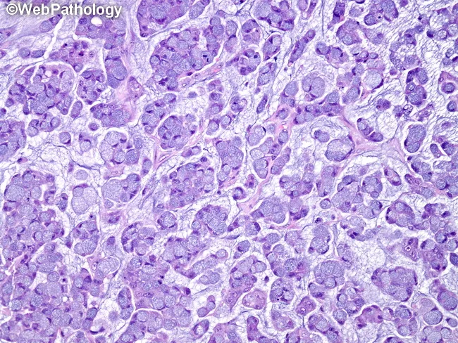 AdenoCA of Colon : Signet Ring Cell