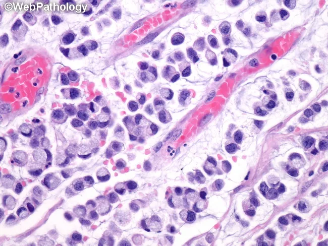 AdenoCA of Colon : Signet Ring Cell