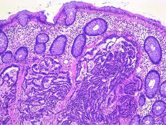 Neuroendocrine Tumors of GI Tract : Classification