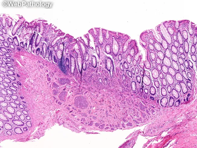 Neuroendocrine Tumors of GI Tract : Classification