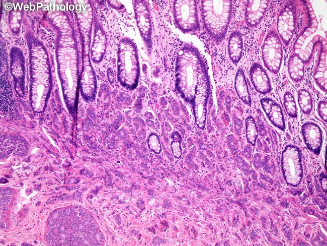 Well-differentiated Neuroendocrine Tumor : Microscopic