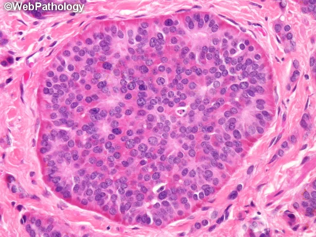 Neuroendocrine Tumors : Mitotic Activity