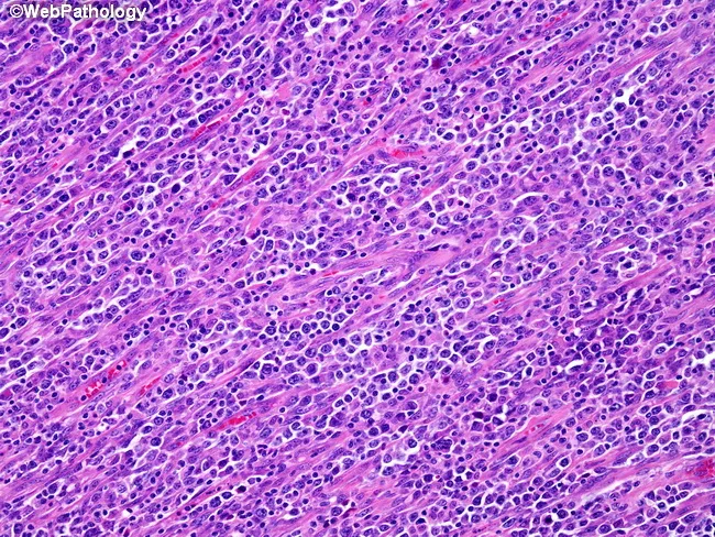 Diffuse Large B-cell Lymphoma : Colon