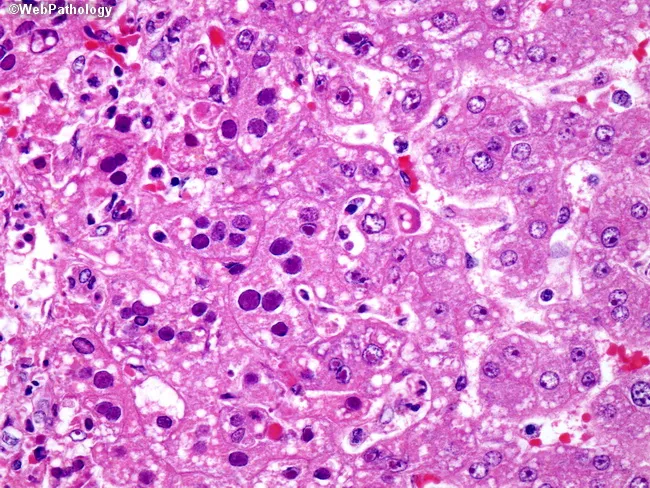 Herpes Simplex Virus Hepatitis