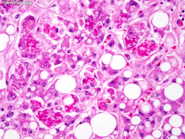 Alcoholic Steatohepatitis : Mallory-Denk Bodies