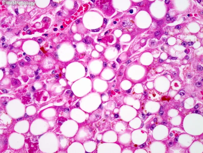 Alcoholic Steatohepatitis : Mallory-Denk Bodies