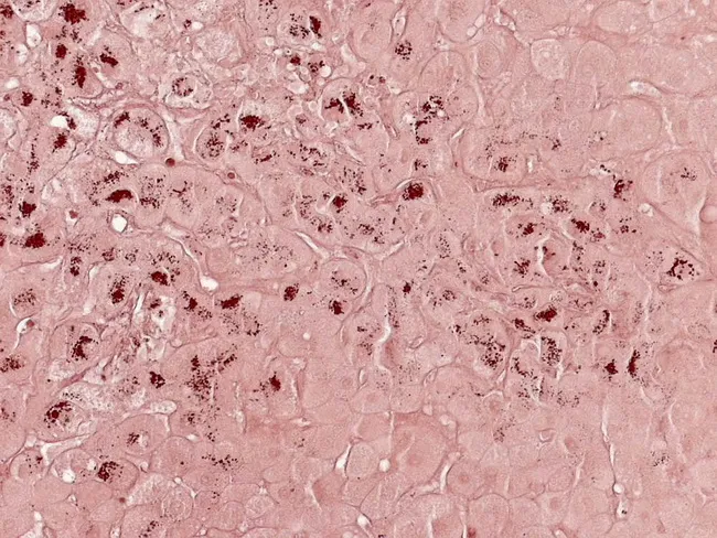Wilson Disease : Orcein Stain