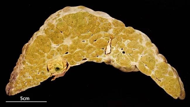 Cirrhosis in Cystic Fibrosis