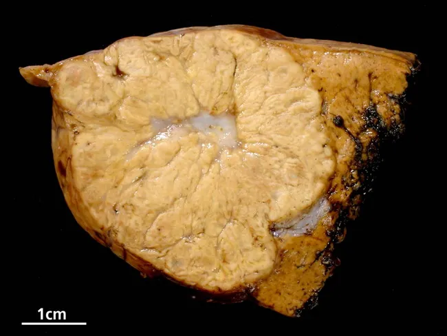 Focal Nodular Hyperplasia : Gross Pathology