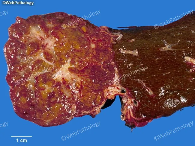 hepatic adenoma gross specimen