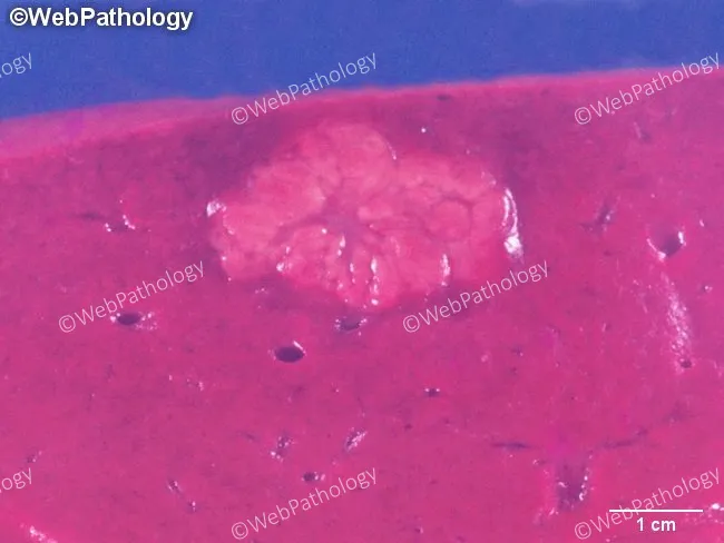 Focal Nodular Hyperplasia : Gross Pathology
