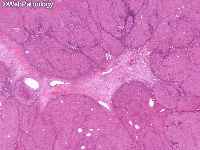 Focal Nodular Hyperplasia Pathology Outlines