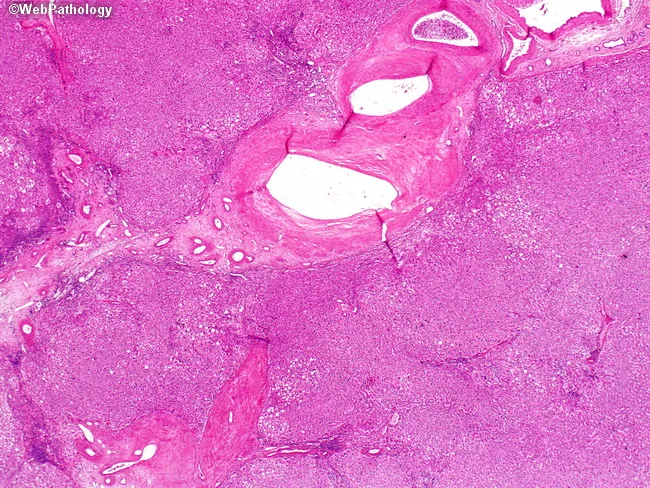 Focal Nodular Hyperplasia Pathology Outlines