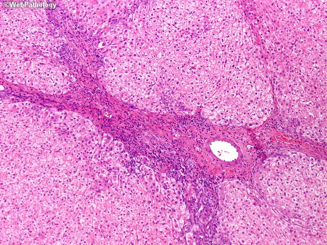 Focal Nodular Hyperplasia : Microscopic