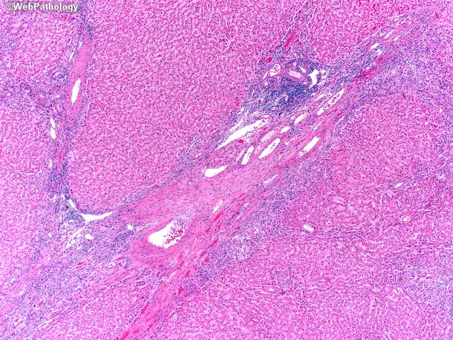 Focal Nodular Hyperplasia : Pathogenesis