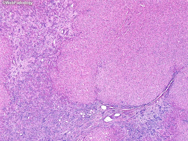 Focal Nodular Hyperplasia : Differential