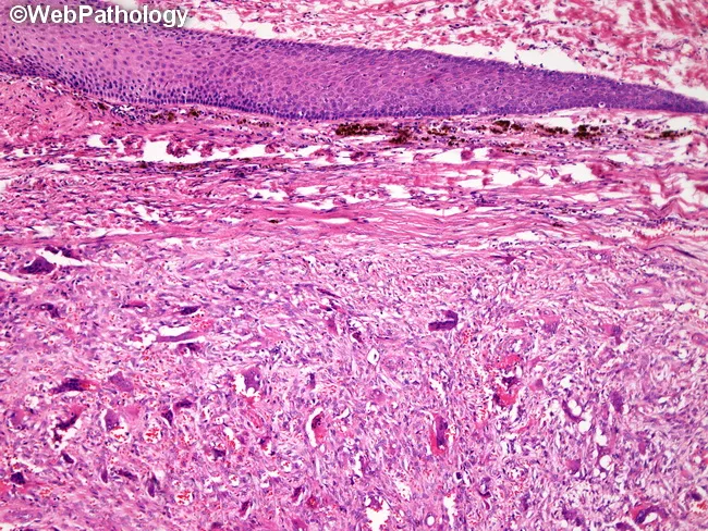 Peripheral Giant Cell Granuloma : Giant Cell Epulis