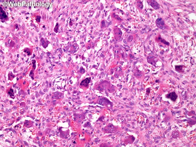 Peripheral Giant Cell Granuloma Peripheral Giant Cell Granuloma