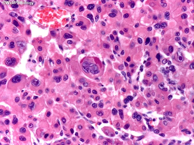 Hepatocellular Carcinoma - Mallory's Hyaline