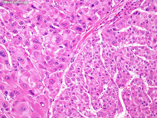 Hepatocellular Carcinoma
