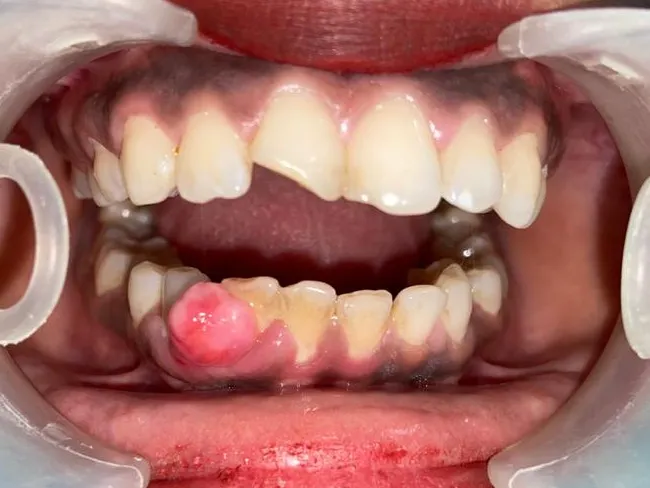 Ossifying Fibroma Oral Cavity