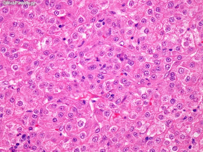 Hepatocellular Carcinoma - Solid Pattern in Hepatitis B