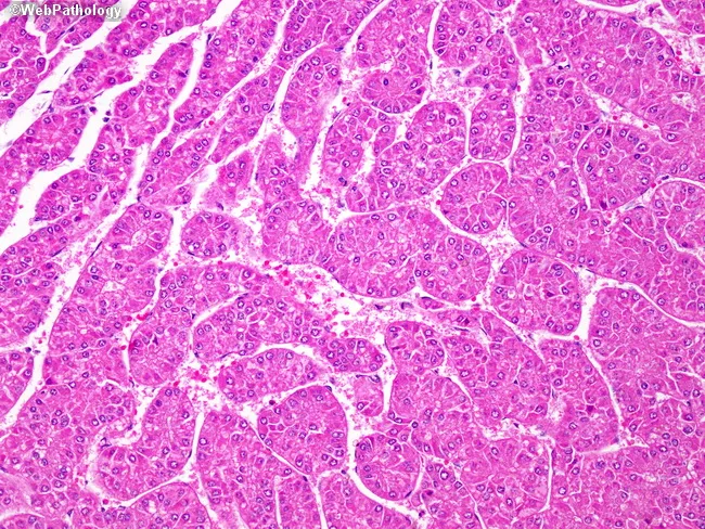 Hepatocellular Carcinoma - Trabecular Pattern in Hepatitis C